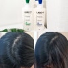 남자 여자 지루성 두피염 탈모 라보에이치 맥주효모 샴푸 추천지성비듬 네이버 블로그